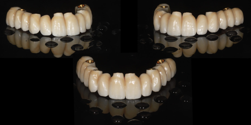 Prótese Total Fixa - Bruno Couto